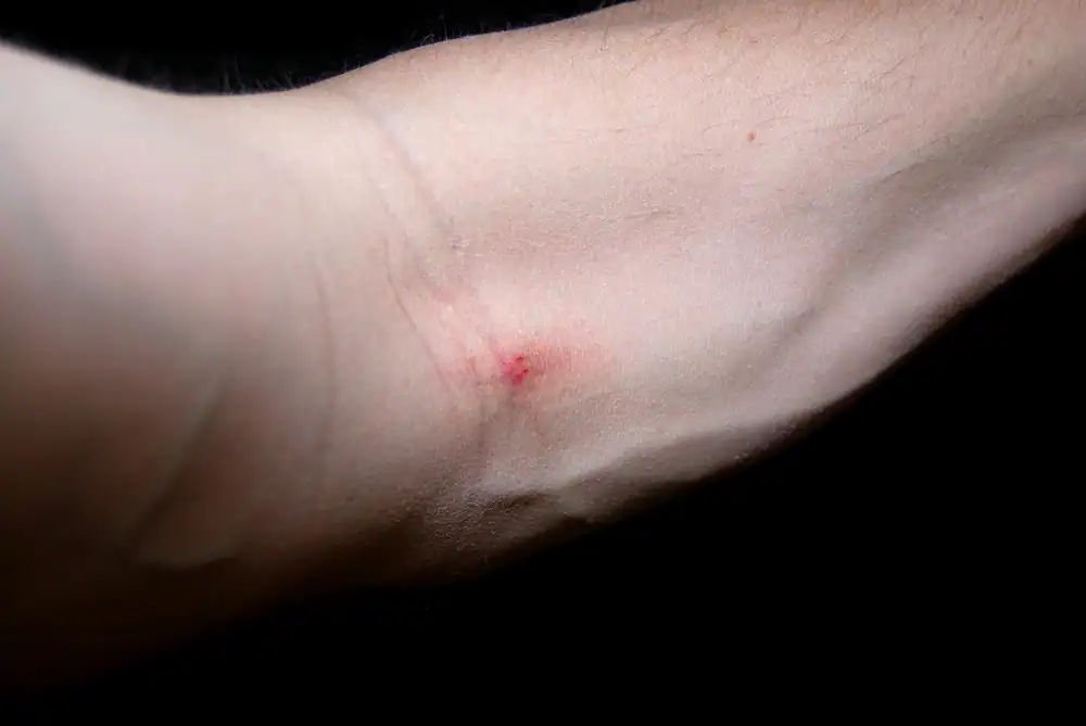 Marks On Someone s Arm Are They Heroin Track Marks Asheville Marks On Someone s Arm Are They Heroin Track Marks Asheville