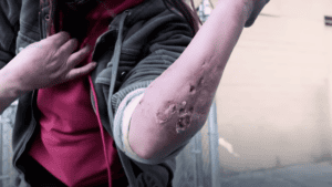 What Is Tranq? Why It's One Of The Worst Drugs |ARC